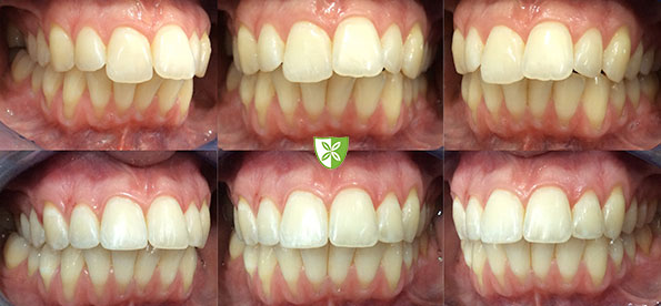 Smile Gallery | Before & After Smile Makeover | SJR Dental