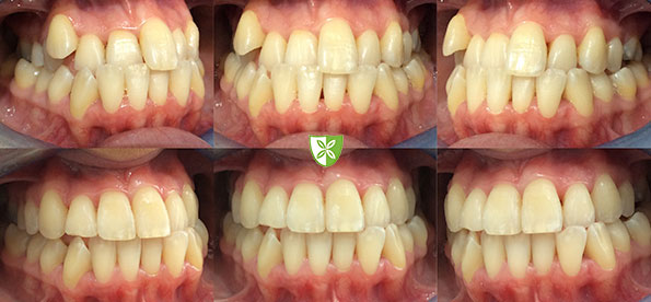 Smile Gallery | Before & After Smile Makeover | SJR Dental