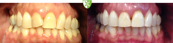 Smile Gallery | Before & After Smile Makeover | SJR Dental