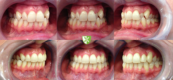Smile Gallery | Before & After Smile Makeover | SJR Dental