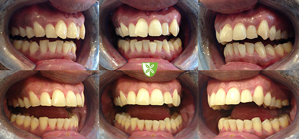 Smile Gallery | Before & After Smile Makeover | SJR Dental