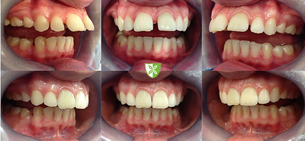 Smile Gallery | Before & After Smile Makeover | SJR Dental