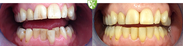 Smile Gallery | Before & After Smile Makeover | SJR Dental