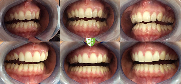 Smile Gallery | Before & After Smile Makeover | SJR Dental